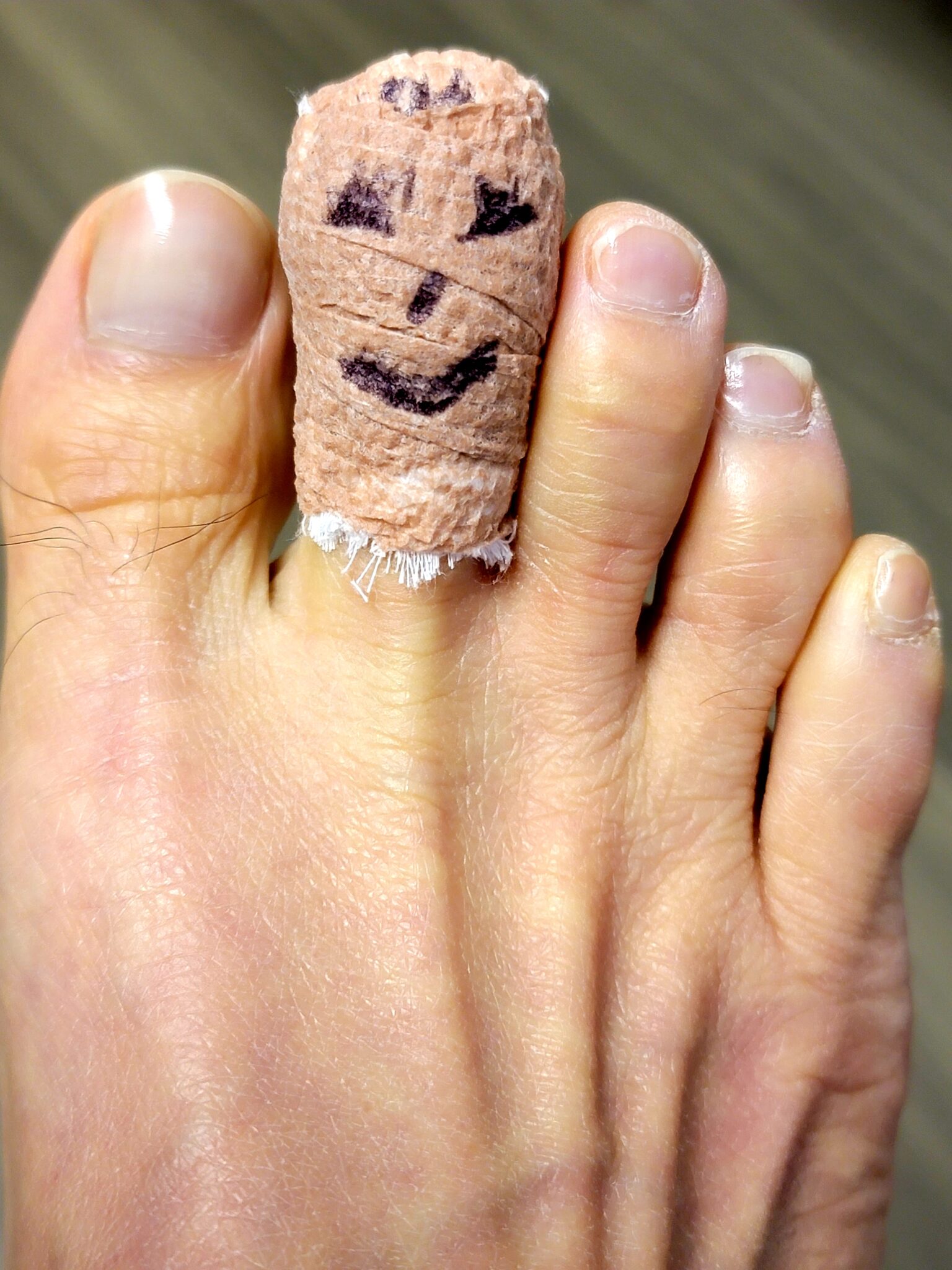 ingrown-toenail-removed-procedure-relief